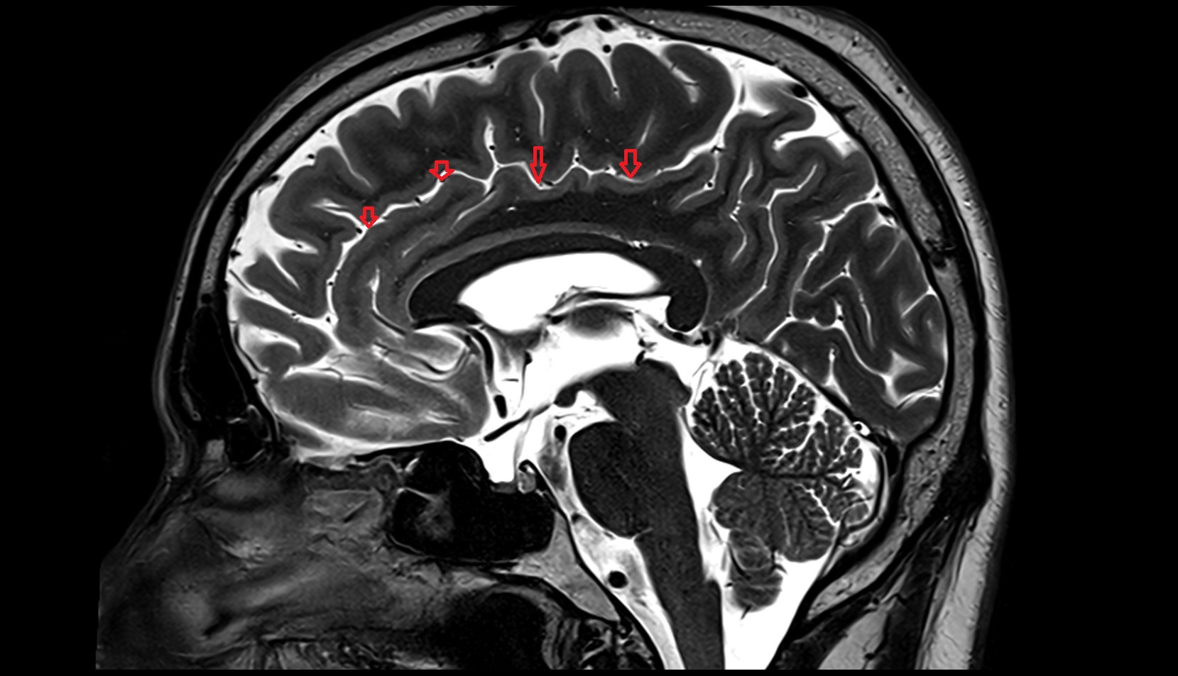 Posterior Commissure: Anatomy, Function, Blood Supply, MRI & CT ...