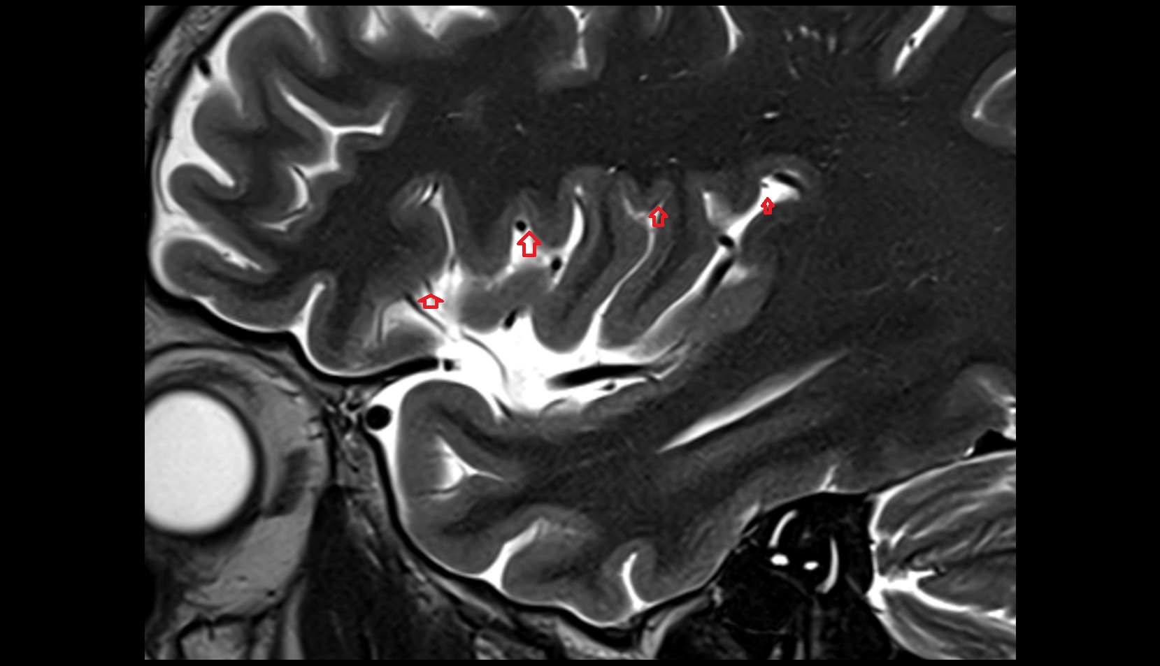 Artery of central sulcus anatomy